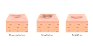 Acne Scars - Dermamode