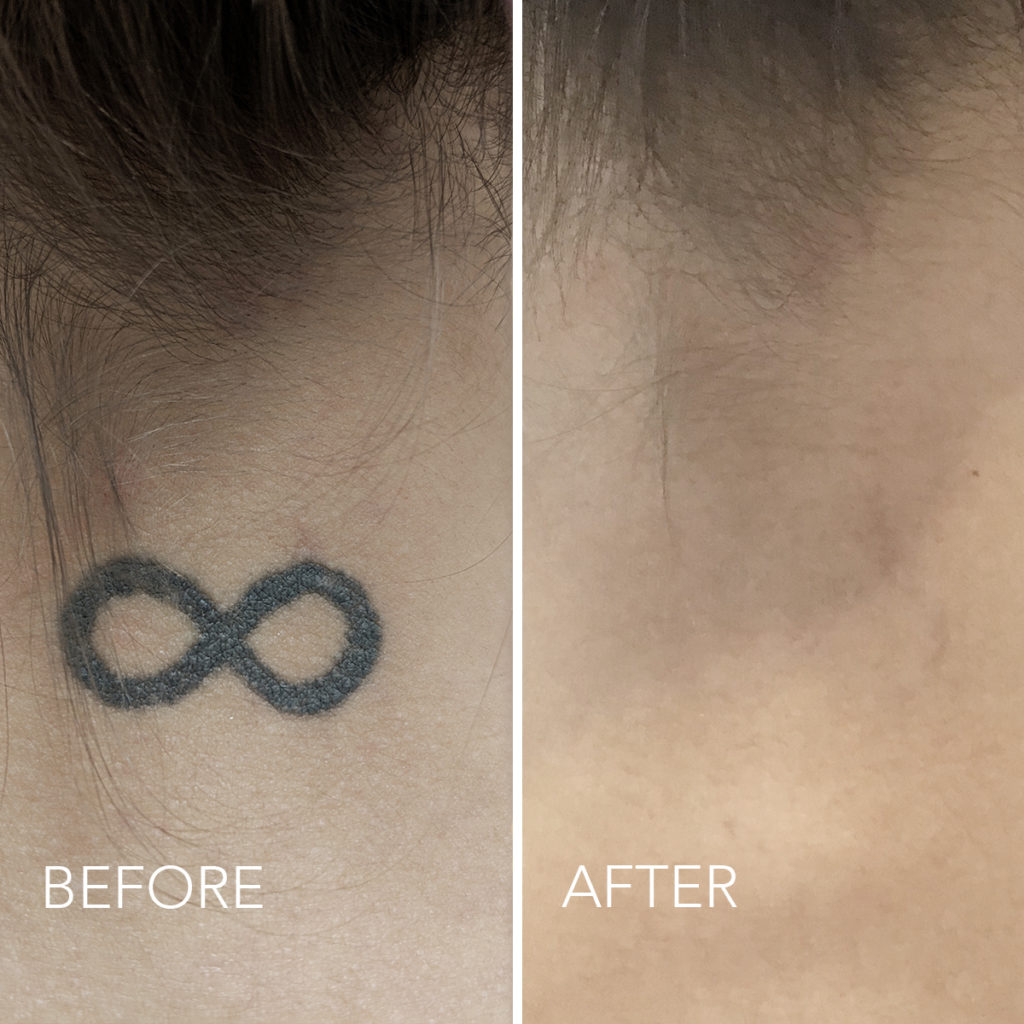 Laser Tattoo Removal Treatment, Montreal - Dermamode