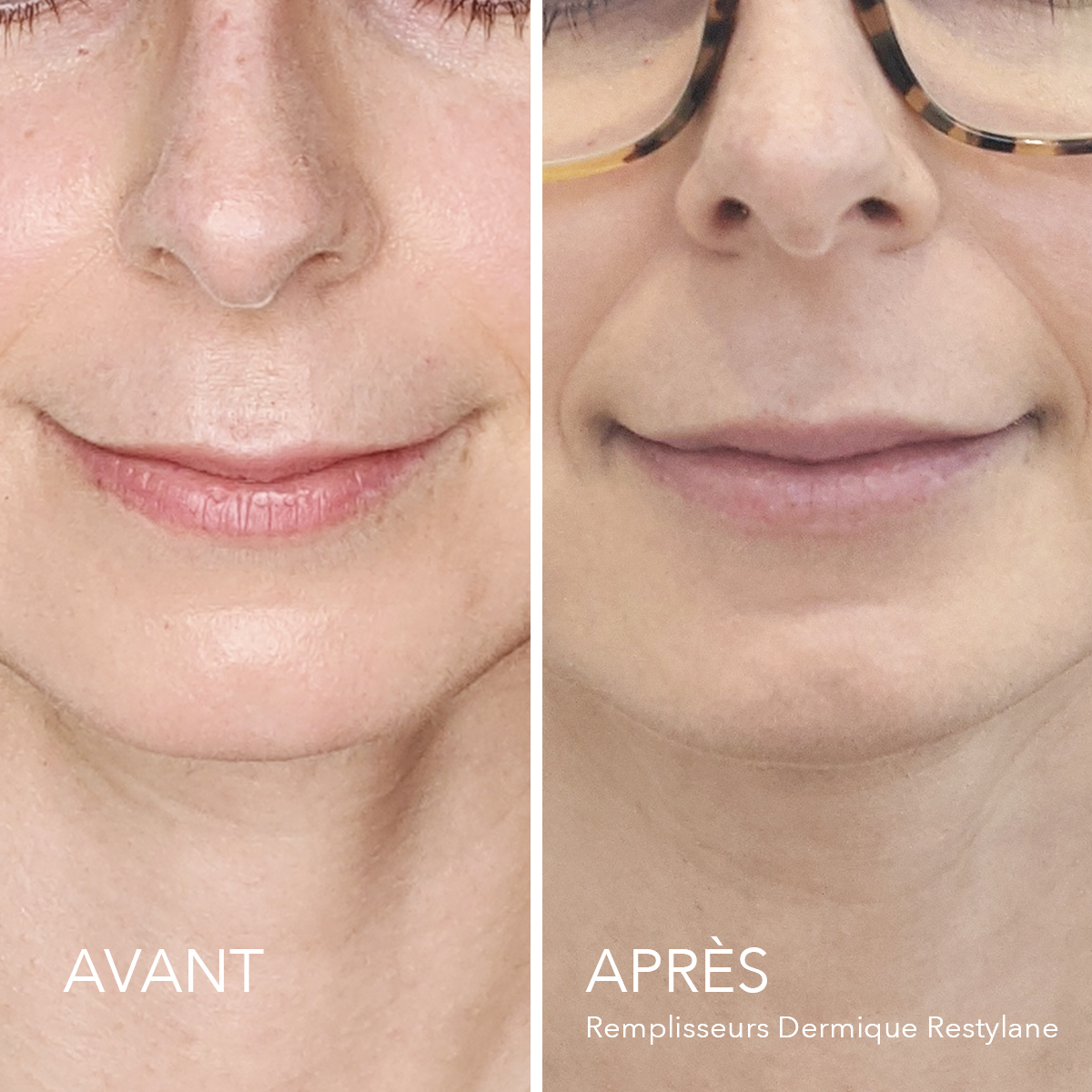 Dermal Fillers in Montreal| Dermamode