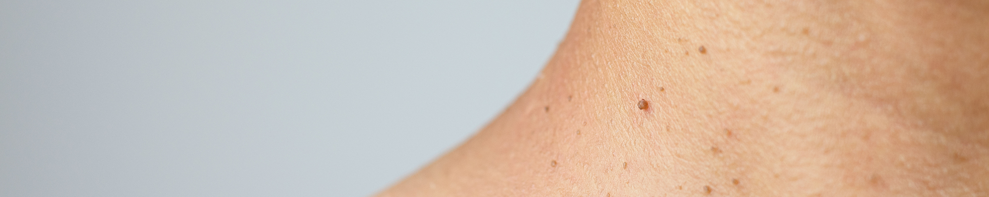 Traitement de Thermocoagulation Vasculyse à Montréal - Dermamode