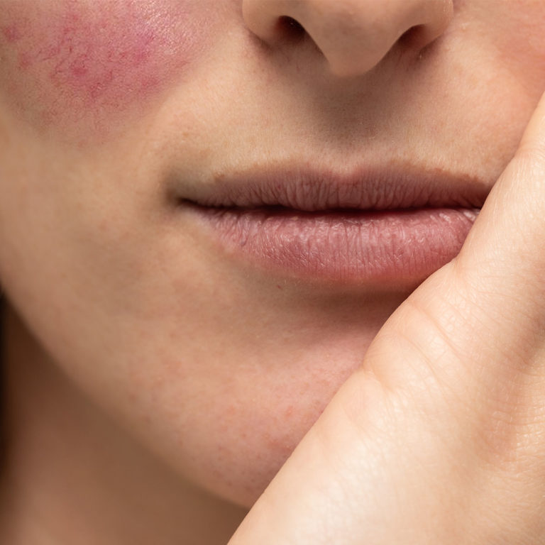 Vbeam PDL Treatment | Vbeam for Rosacea in Montreal at Dermamode