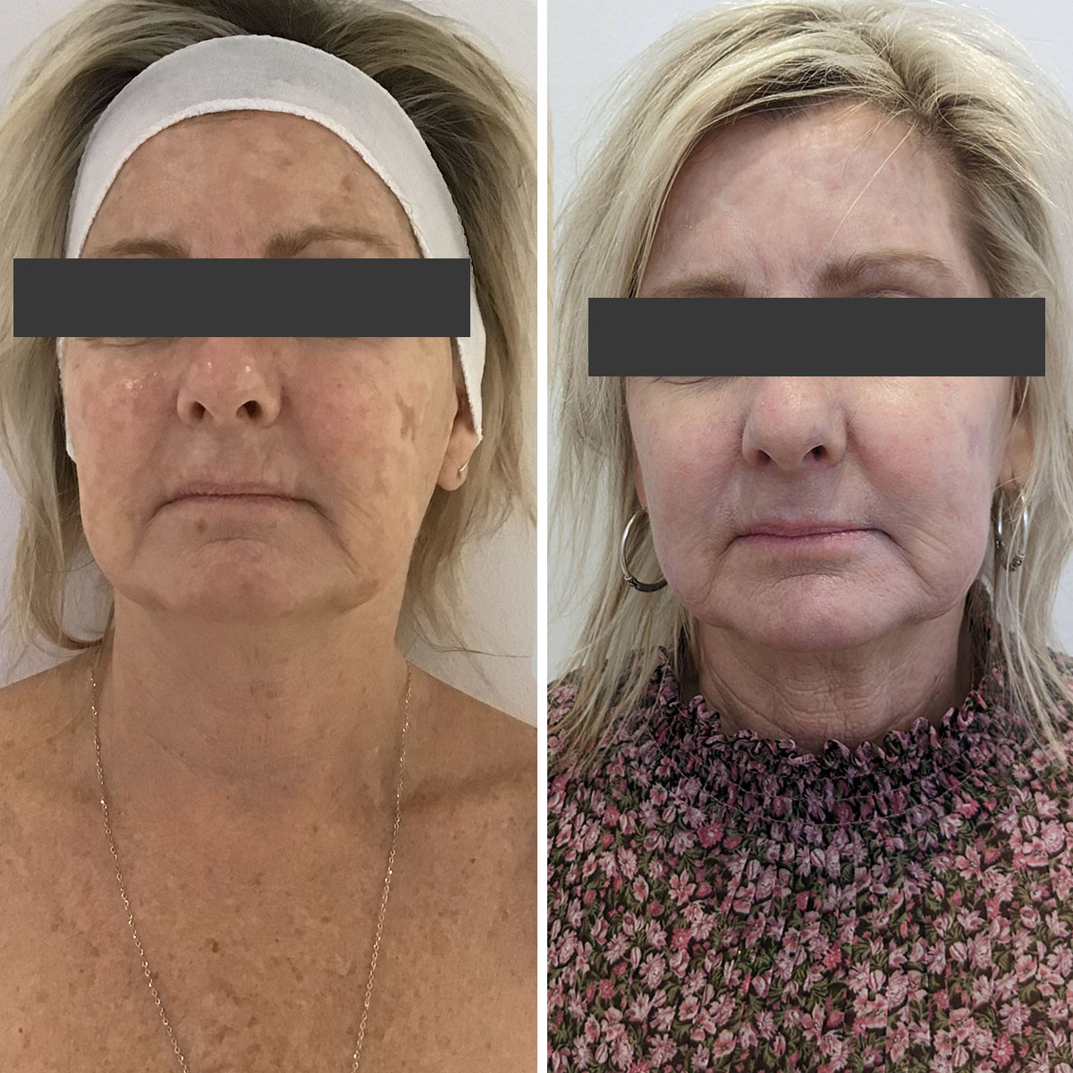 Laser Facial Rejuvenation Treatment Montreal | Fractional Laser ...