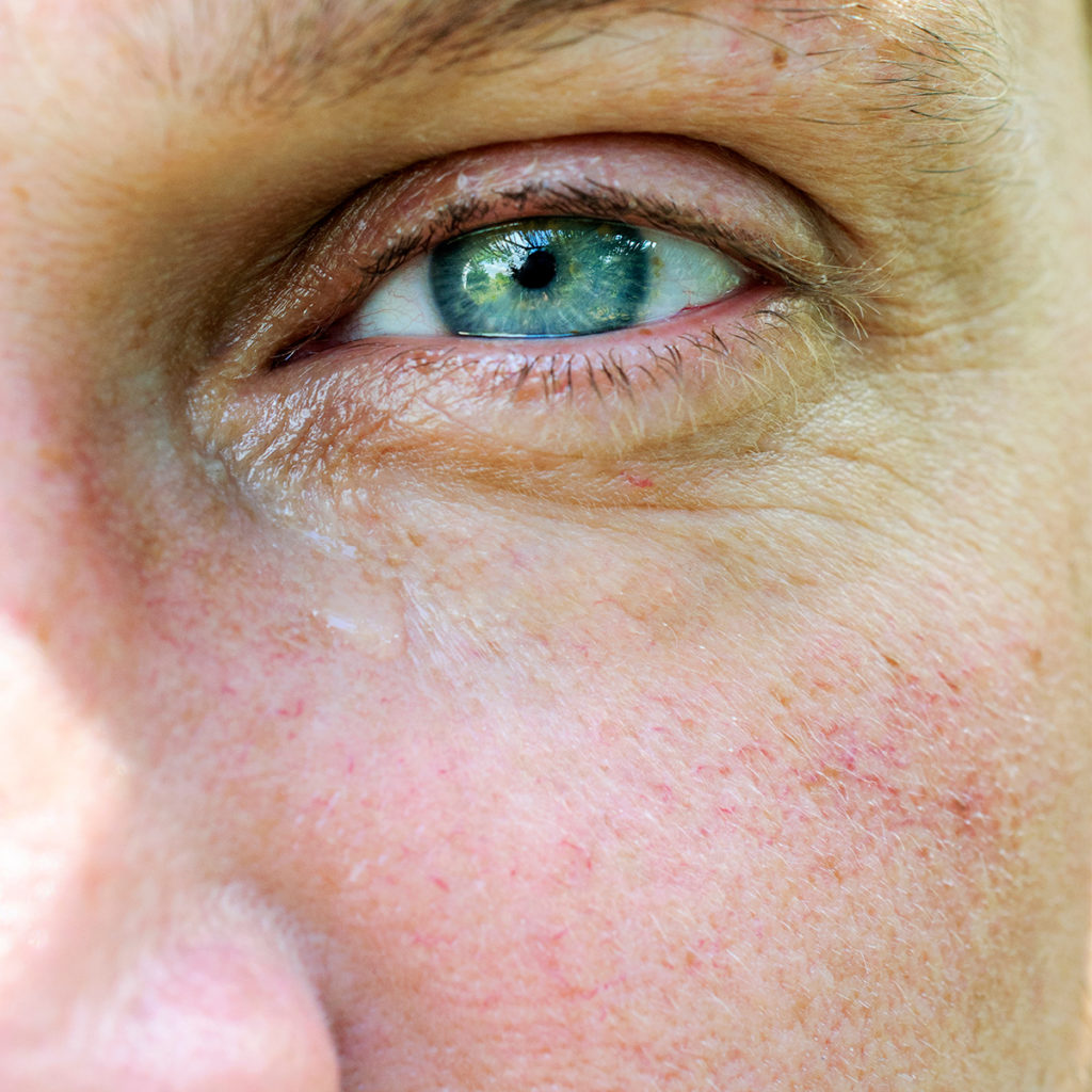 Vivre avec la rosacée | Dermamode